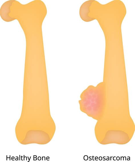 Healthy Bone Osteosarcoma Science Design Illustration Diagram 57313086 Vector Art At Vecteezy