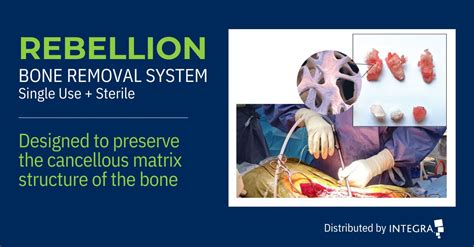 Codman Specialty Surgical On Linkedin Rebellion Bone Removal System