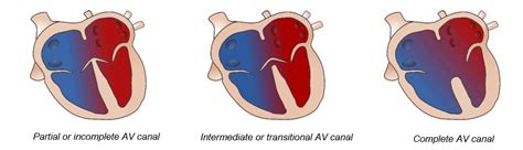 Transitional Av Canal Defect