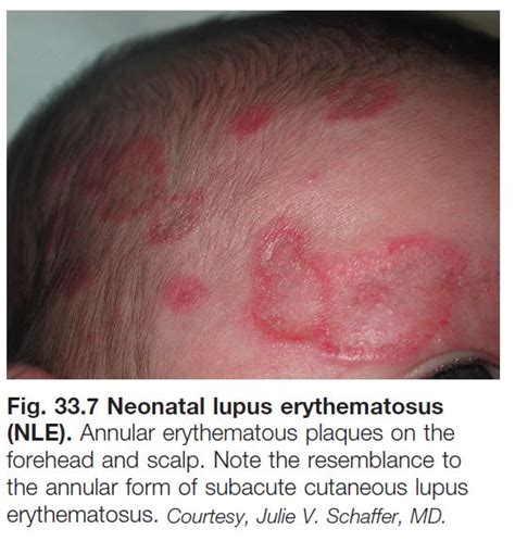 Subacute Cutaneous Lupus Scalp