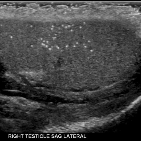Scrotal Ultrasound Updates On Testicular Microlithiasis Incidental