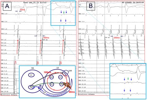 a pacing from the left atrial appendage laa showing the reversal of