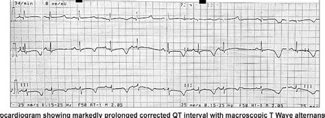 figure 2 from t wave alternans in long qt syndrome semantic scholar