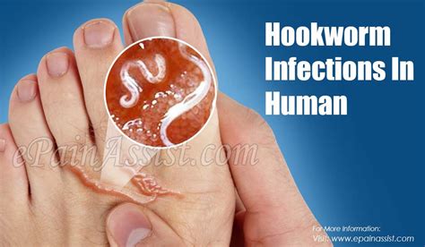 Hook Worms In Human Skin At Jason Criner Blog