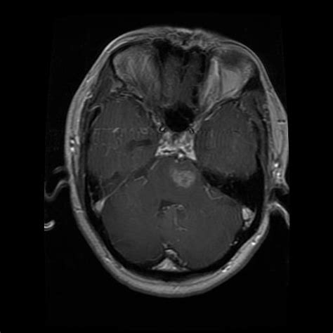 Brain Tumor Object Detection Dataset And Pre Trained Model By Alexandre VAL