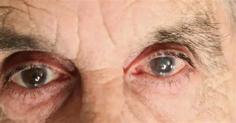 Scleritis Understanding Serious Inflammatory Eye Condition