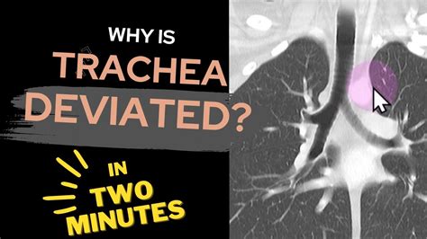 Why Trachea Is Deviated To Right In Two Minutes Youtube