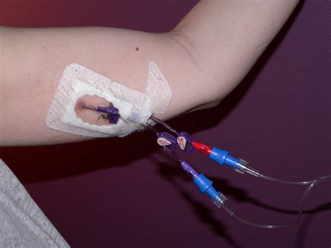 Do Picc Lines Need To Be Flushed Daily At Willie Mixon Blog