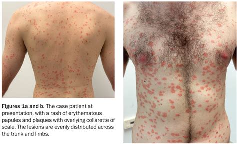What Is A Papular Rash