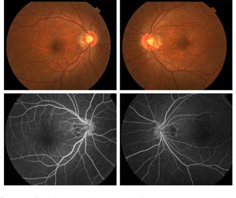 figure 2 from pattern reversal visual evoked potential in patients with
