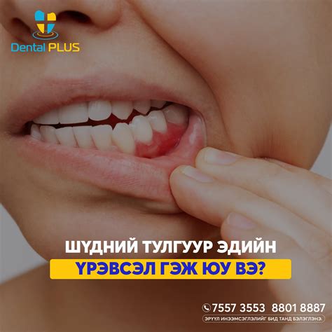 Б Хандсүрэн Энэ нь шүд сулрах өвчин буюу буйлны үрэвслээс үүдэлтэй буйлнаас цус гаран буйл