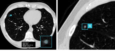 Figure 1 From Pulmonary Nodule Detection In Ct Scans With Equivariant
