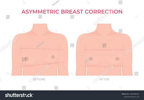 Asymmetric Breast Correction Before After Plastic Stock Vector Royalty