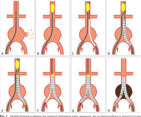 Figure 1 From Ruptured Abdominal Aortic Aneurysm Treated By Double