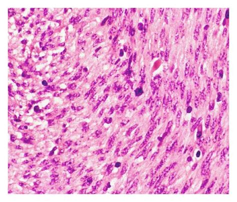 A Conventional Radiograph Reveals An Osteolytic Lesion In