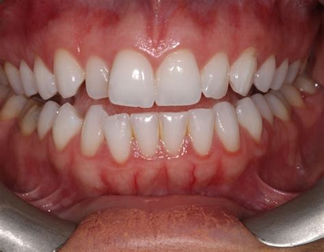 Spark Aligners From £100 Pm Interest Free Myodental