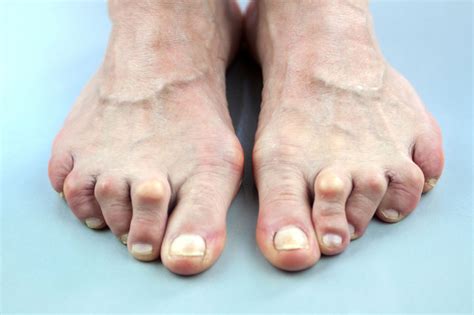 Managing Rheumatoid Arthritis In The Feet In La Eazy Foot