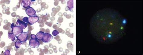 Burkitt Type Acute Lymphoblastic Leukemia With Precursor B C Medicine