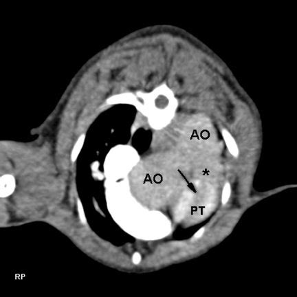 The Photo Was Taken During The PDA Ligating Surgery The PDA Download Scientific Diagram
