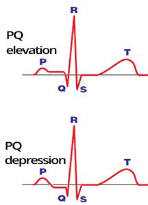 Pq Segment Ecg
