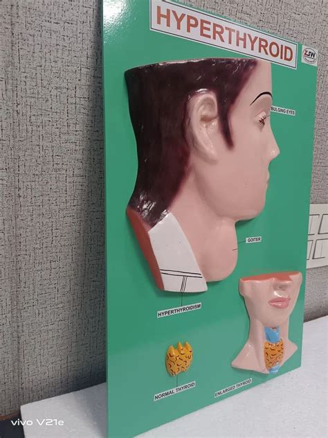 Wooden Hyperthyroid Model At ₹ 3850piece In Ambala Id 2856869607573