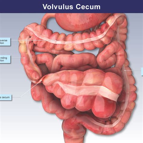 Sigmoid Volvulus Trial Exhibits Inc