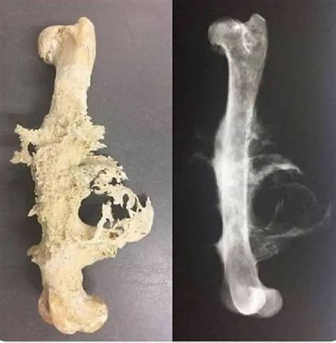 Osteosarcoma Is A Malignant Tumors Which Begins In The Bone Forming