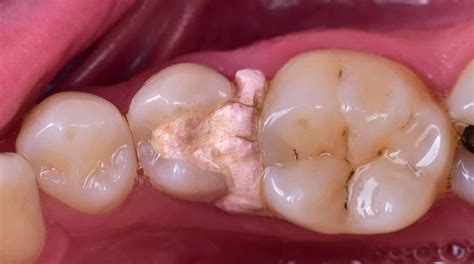 Deep Margin Elevation With Associated Class Two Myzerodonto