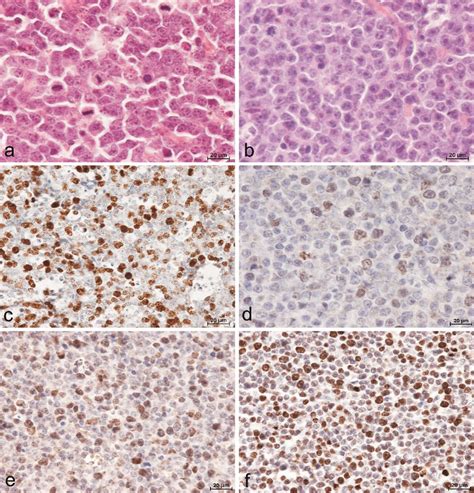Lymphomas Of Diffuse Architecture Composed Of Large B Cells A Download Scientific Diagram
