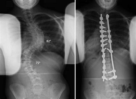 Scoliosis Archives New Mexico Orthopaedic Associates
