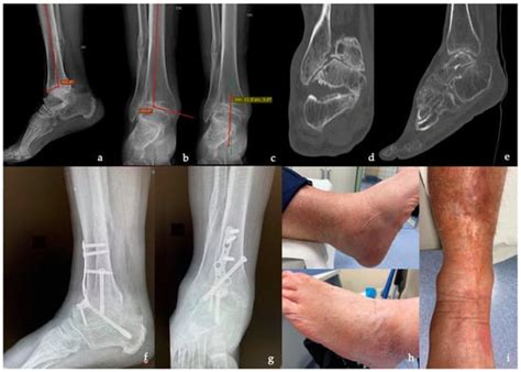 Tibiotalar And Tibiotalocalcaneal Arthrodesis With Paragon28