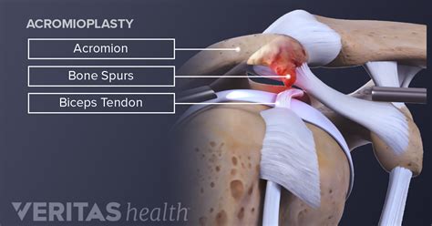 Shoulder Bursitis Injection
