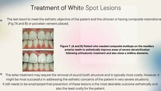 White Spot Lesions Formation Prevention And Treatmentpdf