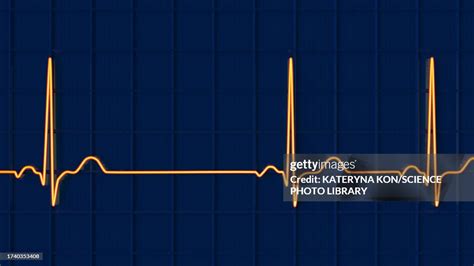 Sinus Arrhythmia Heartbeat Rhythm Illustration High Res Vector Graphic