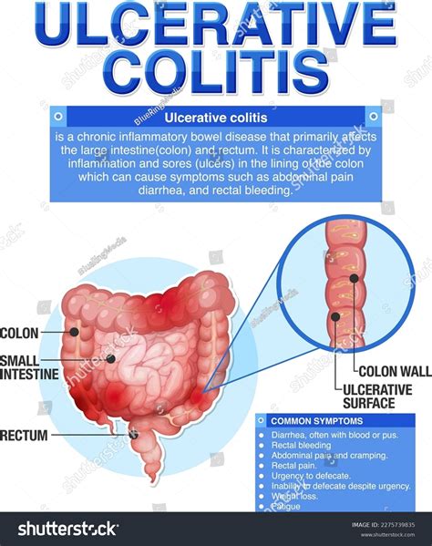 Ulcerative Colitis Symptoms Infographic Illustration Stock Vector Royalty Free 2275739835