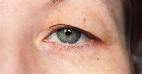 ارتخاء الجفن ما بين الأعراض والأسباب ويب طب
