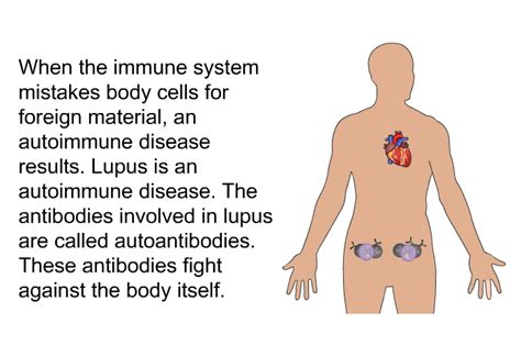 Lupus