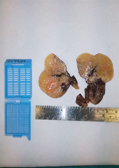 A B Macroscopic View Of The Inflamed Epiploic Appendix After