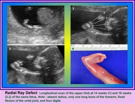Limb Reduction Defects Department Of Obstetrics And Gynecology Faculty Of Medicine Chiang Mai