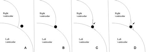 detection myocardial bridging using non invasive technique intechopen