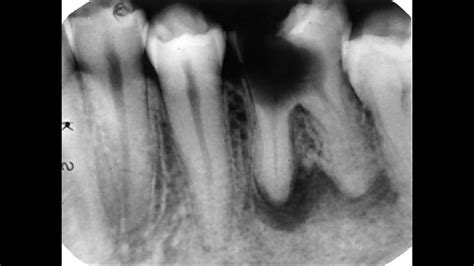 Apical Periodontitis Vs Irreversible Pulpitis Design Talk