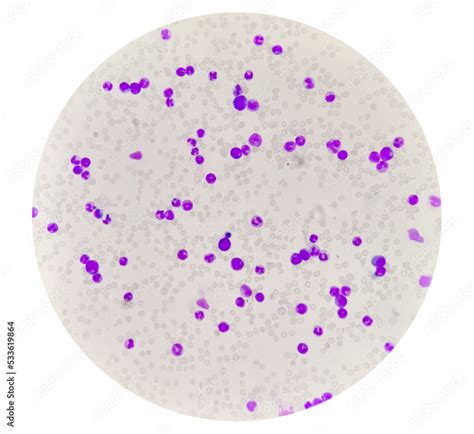 Burkitts Lymphoma Cells Is A Cancer Of The Lymphatic System A