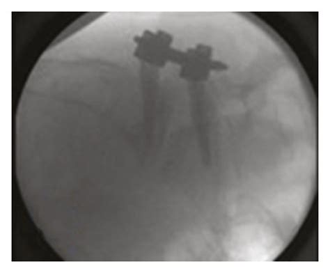 Grade 2 L5 S1 Spondylolisthesis With The Bilateral Pars Defect A