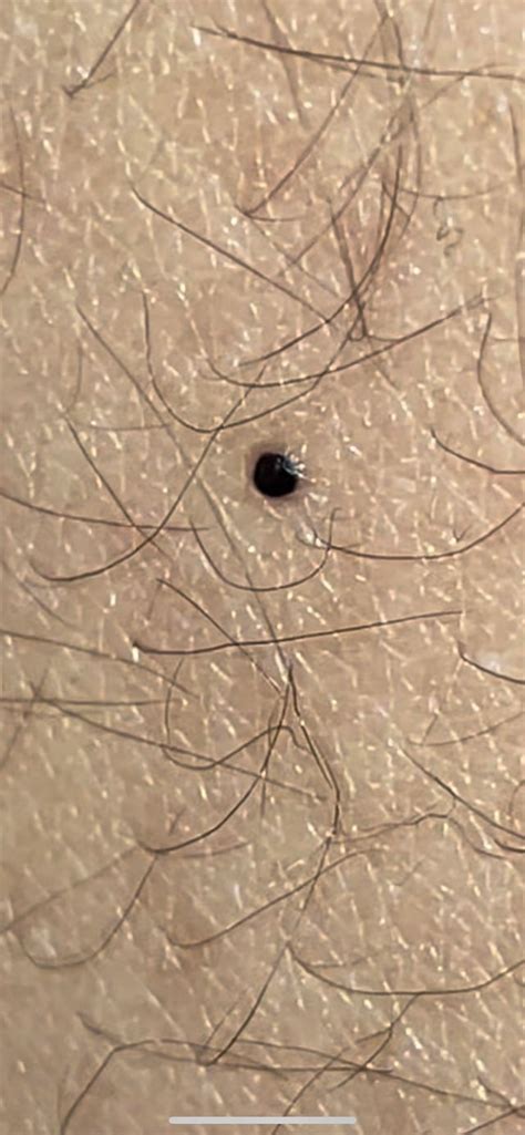 This Small Black Dot Appeared On My Skin What Is It Its On My Back Rmelanoma