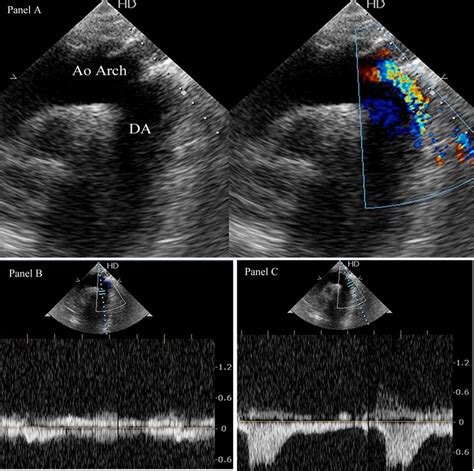 A Colour Comparison Of Aortic Arch From Suprasternal View Showing No Download Scientific