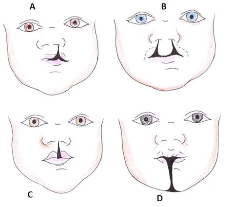 Cleft Lip Diagram