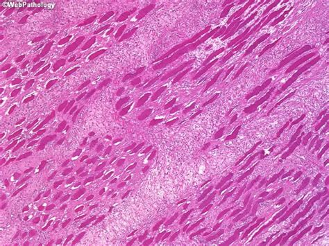 Proliferative Myositis Intro And Clinical
