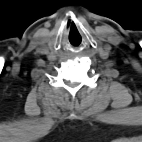 Radiopaedia Case Severe Spinal Canal Stenosis Id 38265 Study 40288