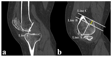 Technique Of Osteophyte Size Measurement A Midsagittal Section Of