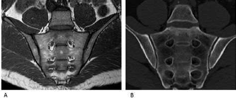 Sacroiliitis Findings On Conventional Radiography Ct And Mri Studies